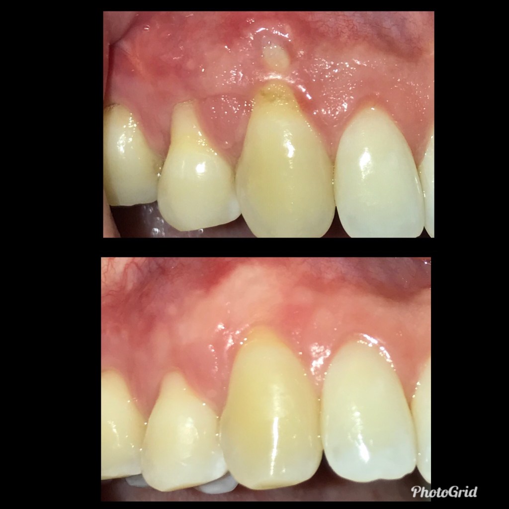 Gum Surgery Before & Afters Lawndale CA, Vadadent Dental Group